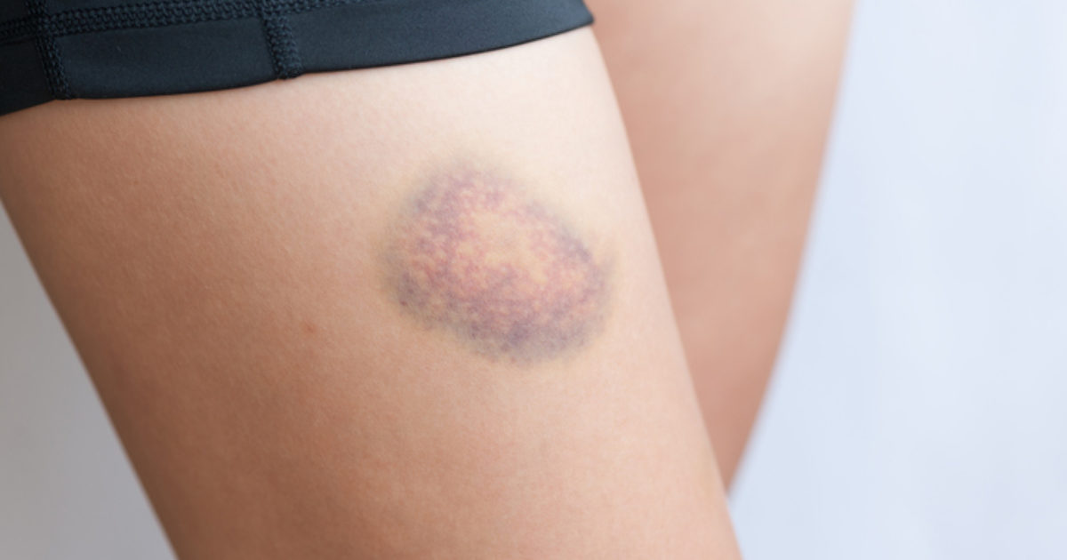 Do Varicose Veins Cause Bruising